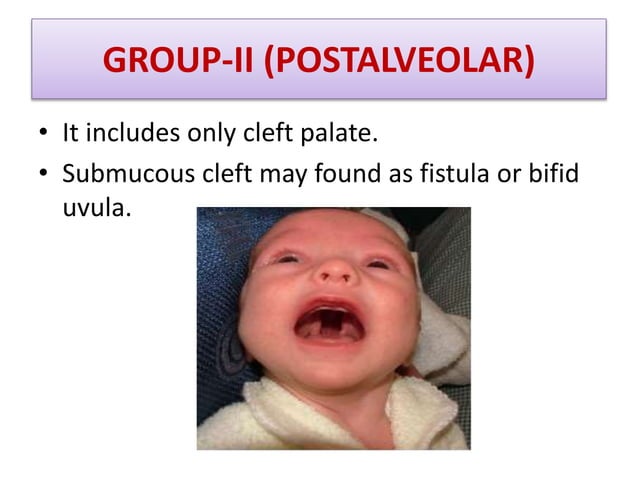 Cleft lip and cleft palate | PPTX | Ear, Nose and Throat Conditions ...