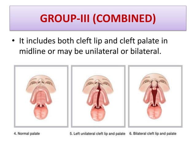 Cleft lip and cleft palate | PPTX | Ear, Nose and Throat Conditions ...
