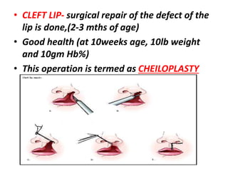 Cleft lip and cleft palate | PPTX