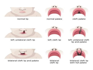 Cleft lip and cleft palate | PPTX