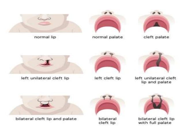 Cleft lip and cleft palate | PPTX | Ear, Nose and Throat Conditions ...