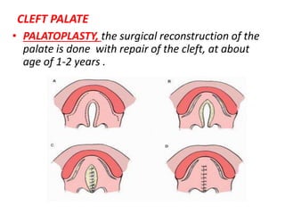 Cleft lip and cleft palate | PPTX