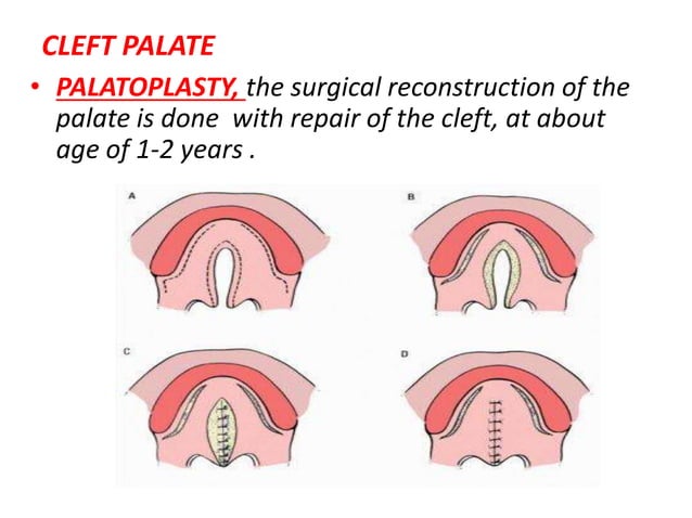 Cleft lip and cleft palate | PPTX | Ear, Nose and Throat Conditions ...