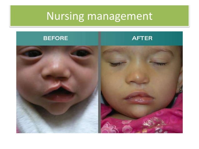 Cleft lip and cleft palate | PPTX | Ear, Nose and Throat Conditions | Diseases and Conditions