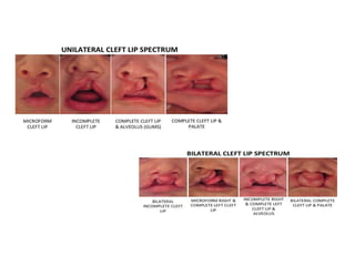 Cleft lip and cleft palate | PPTX