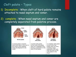 Cleft lip and cleft palate | PPT