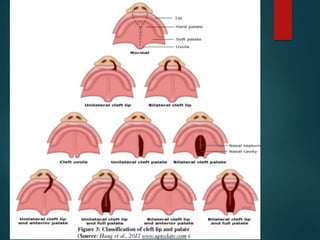 Cleft lip and cleft palate | PPTX