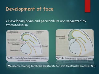 Cleft lip and cleft palate | PPTX