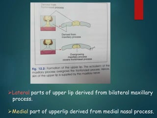 Cleft lip and cleft palate | PPTX