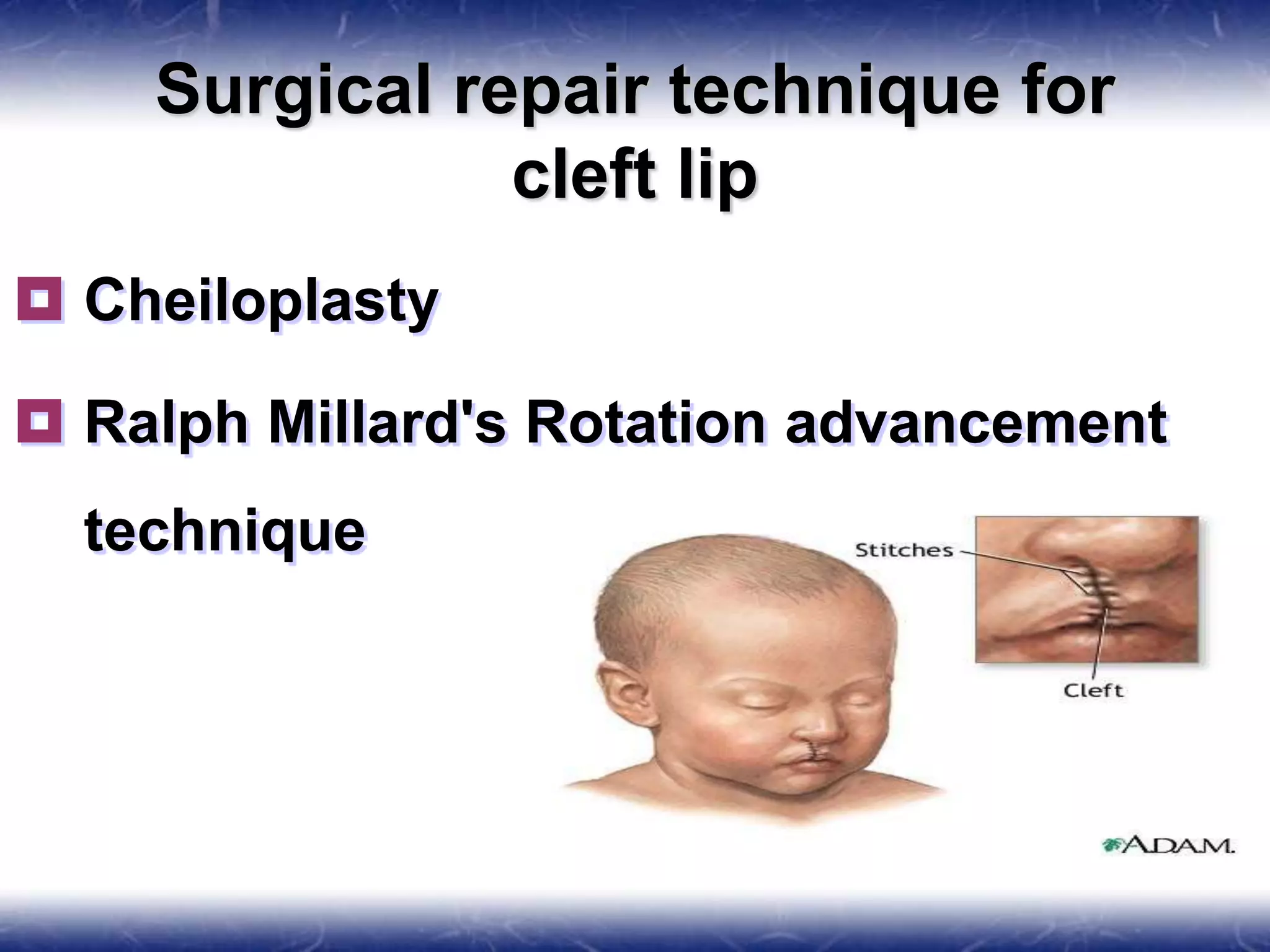 Cleft lip and cleft palate | PPTX