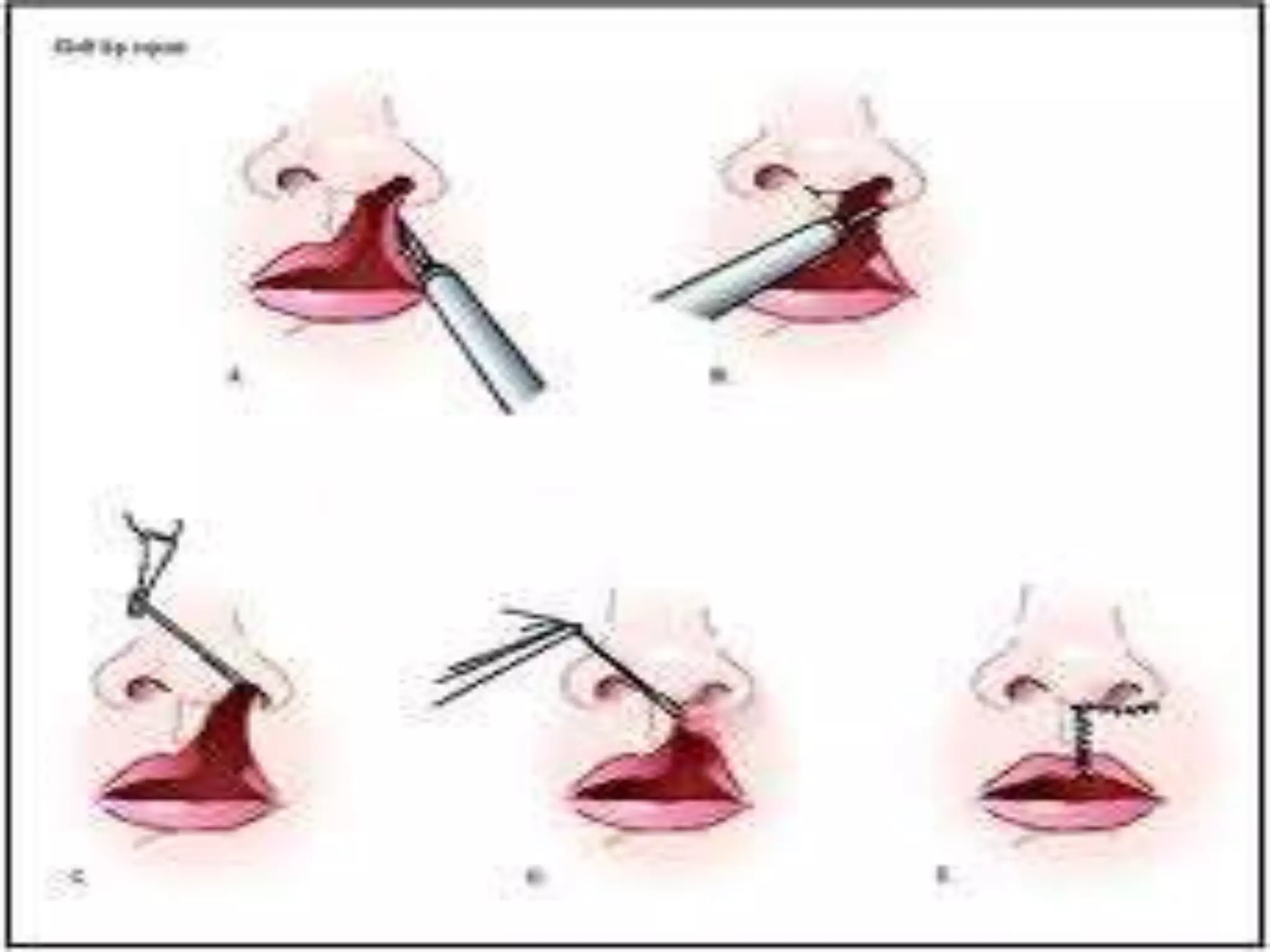 Cleft lip and cleft palate | PPTX