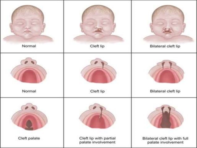 Cleft lip and cleft palate | PPTX
