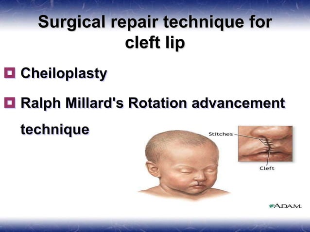 Cleft lip and cleft palate | PPTX