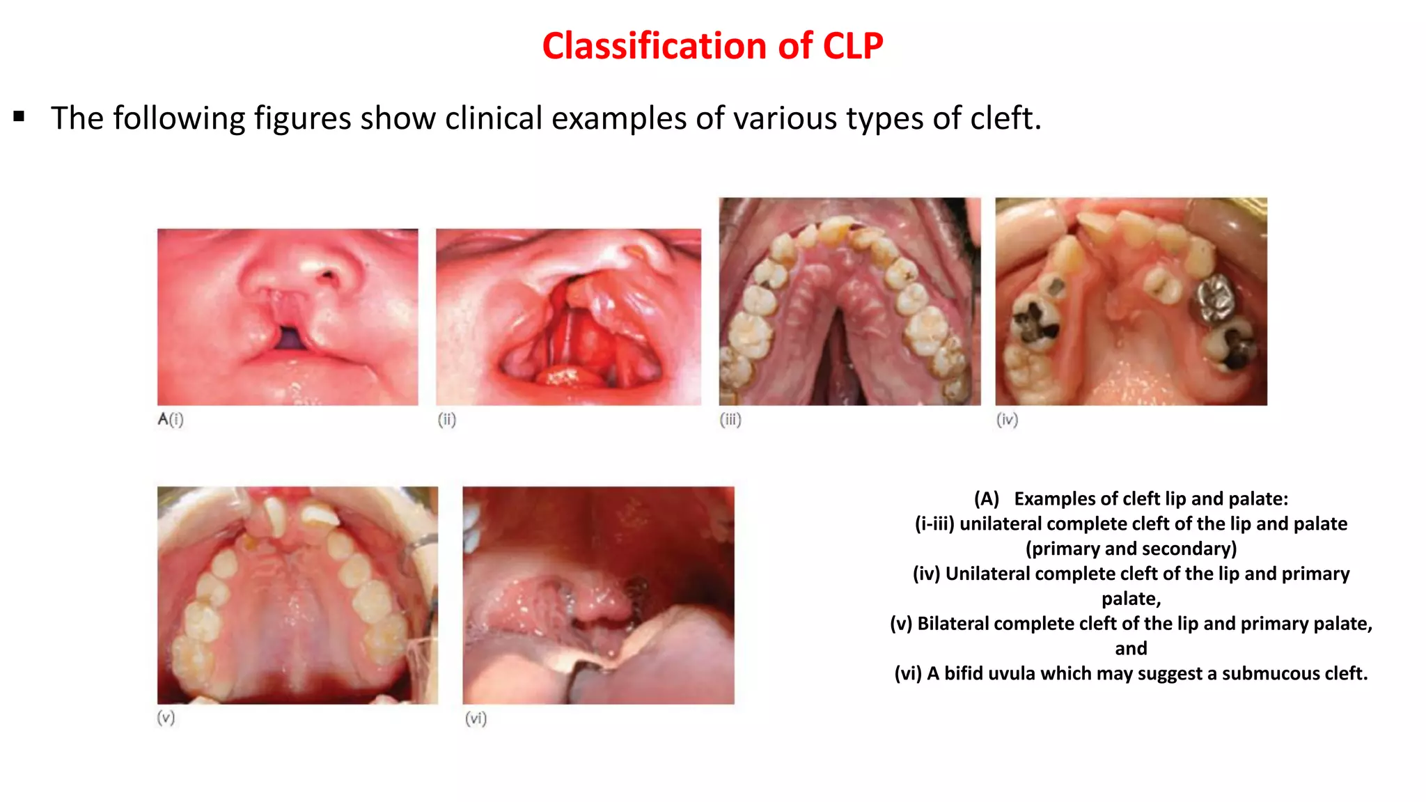 cleft lip and cleft palate.pdf