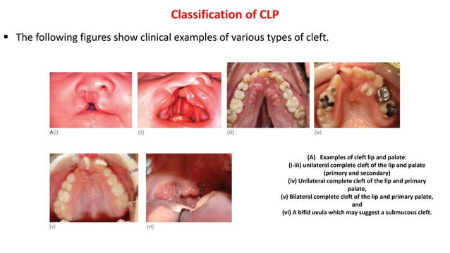 cleft lip and cleft palate.pdf
