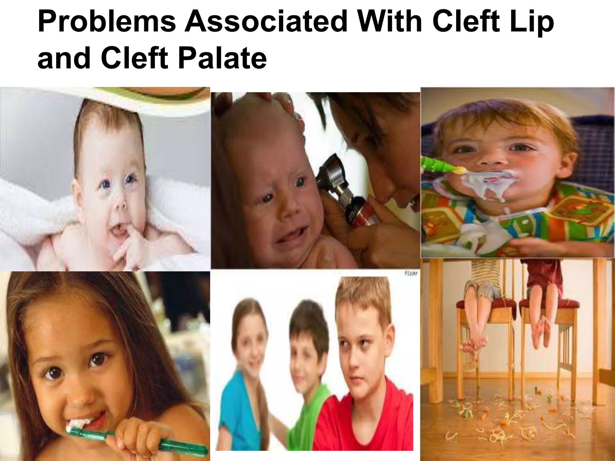 Cleft lip and cleft palate.ppt