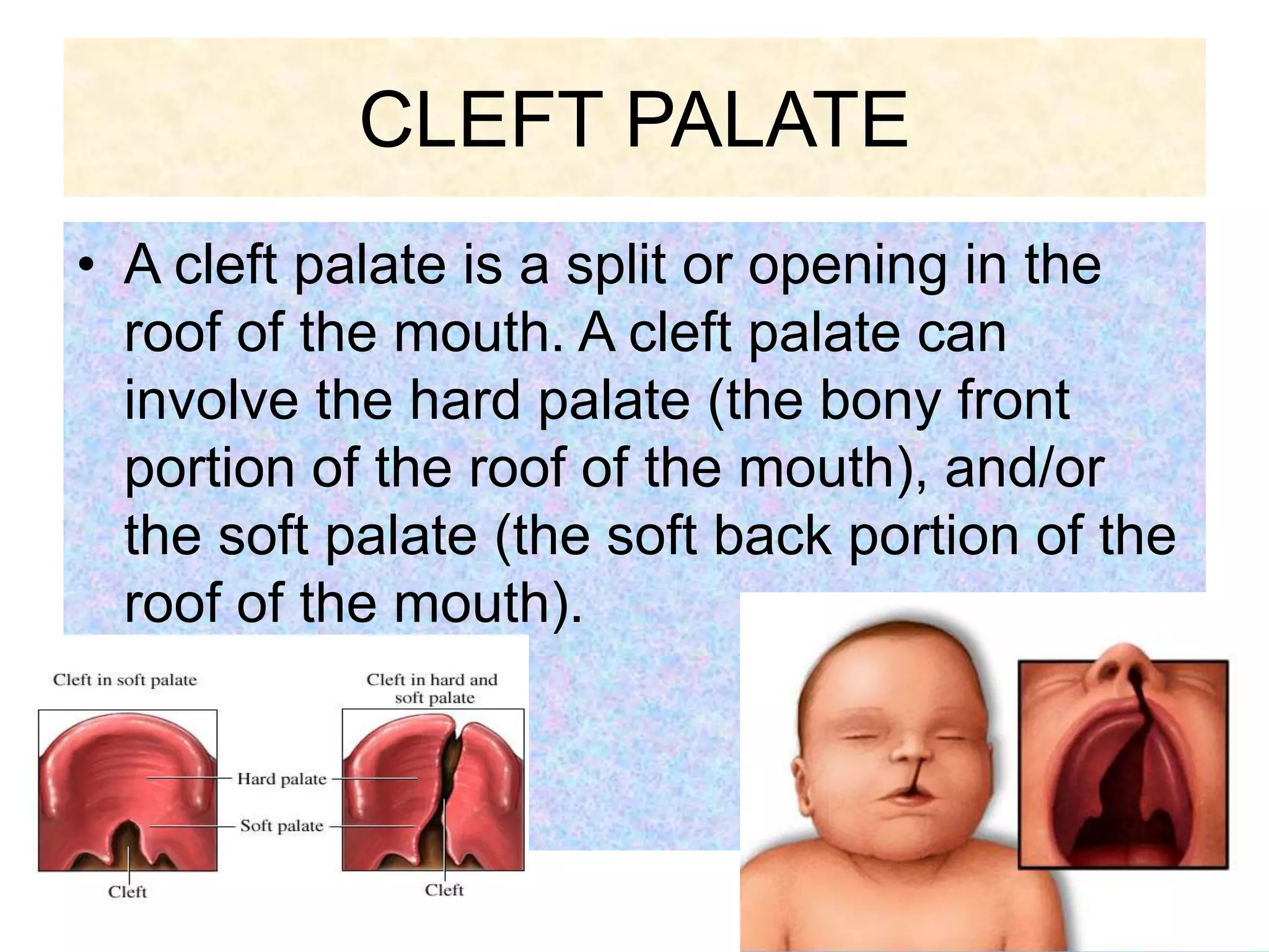 Cleft lip and cleft palate.ppt