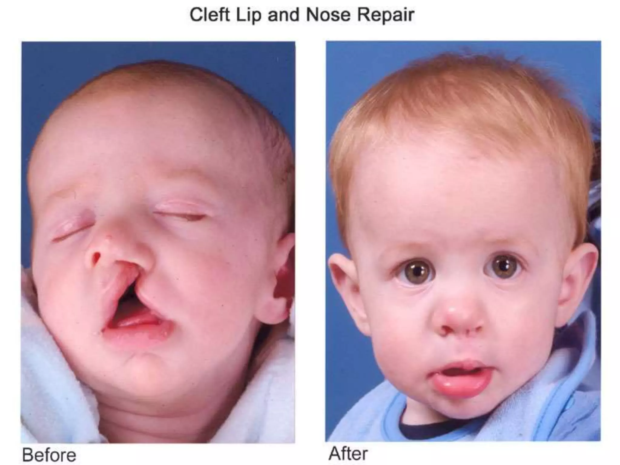 Cleft lip and cleft palate.ppt