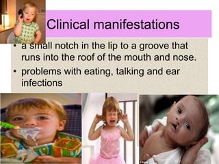 Cleft lip and cleft palate.ppt