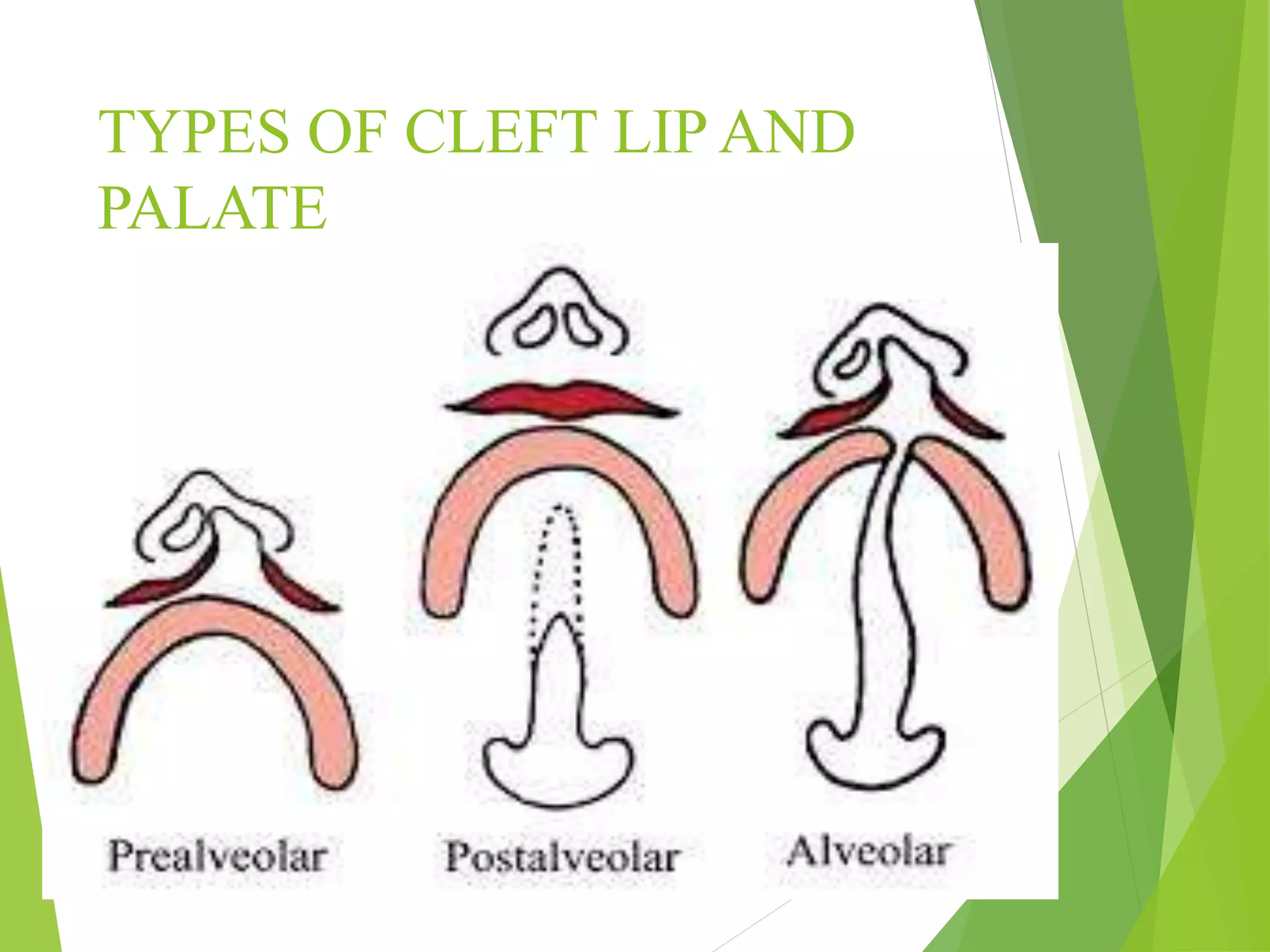 cleft lip and cleft palate.pptx | Pregnancy | Reproductive Health