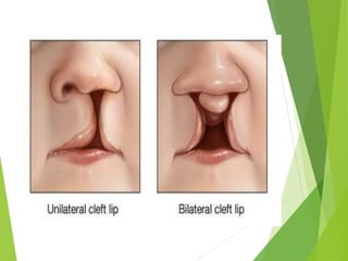 cleft lip and cleft palate.pptx | Pregnancy | Reproductive Health