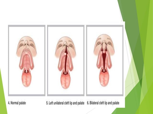 cleft lip and cleft palate.pptx