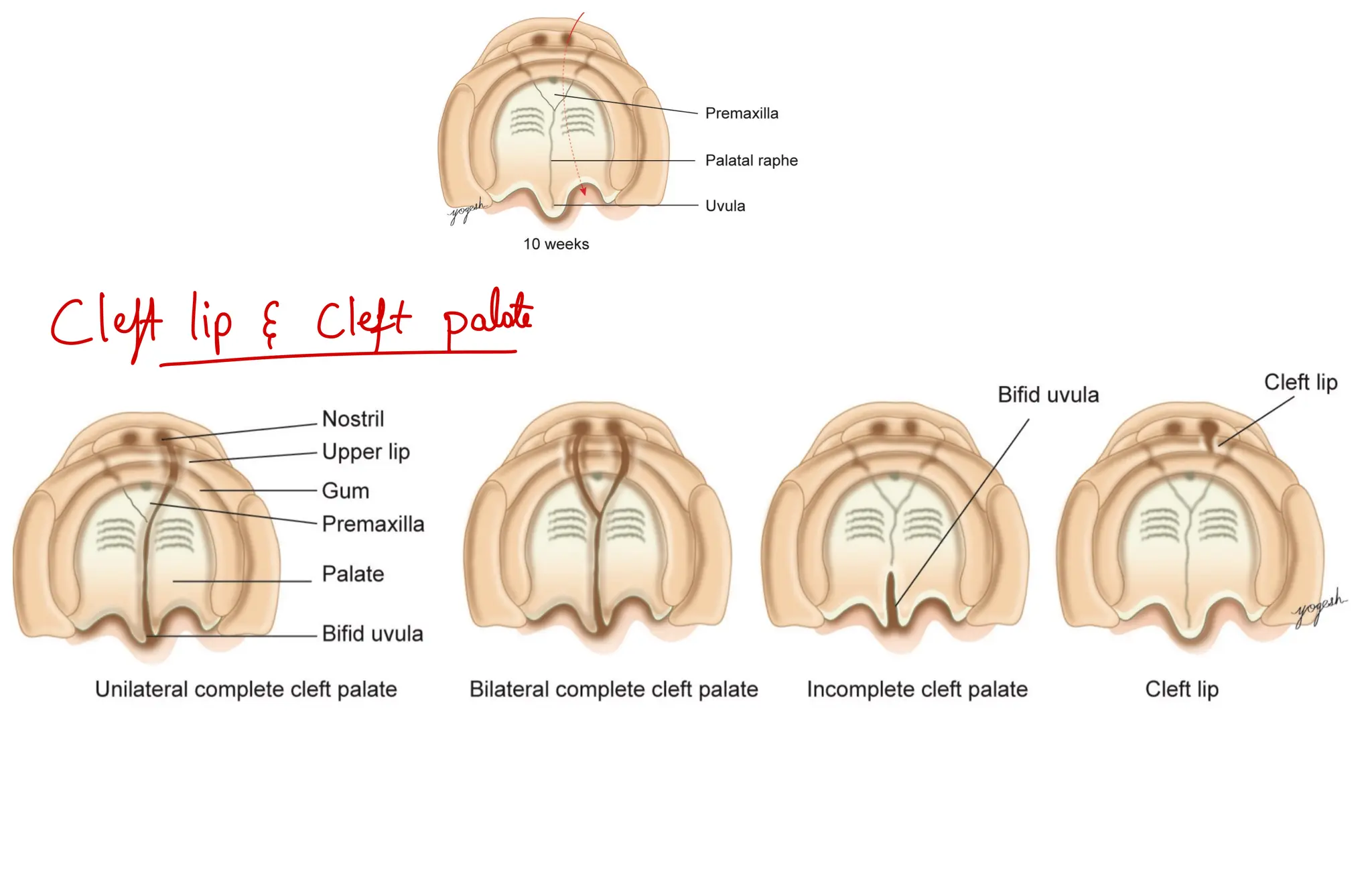 Cleft Lip And Cleft Palate.pdf.......... | PPT
