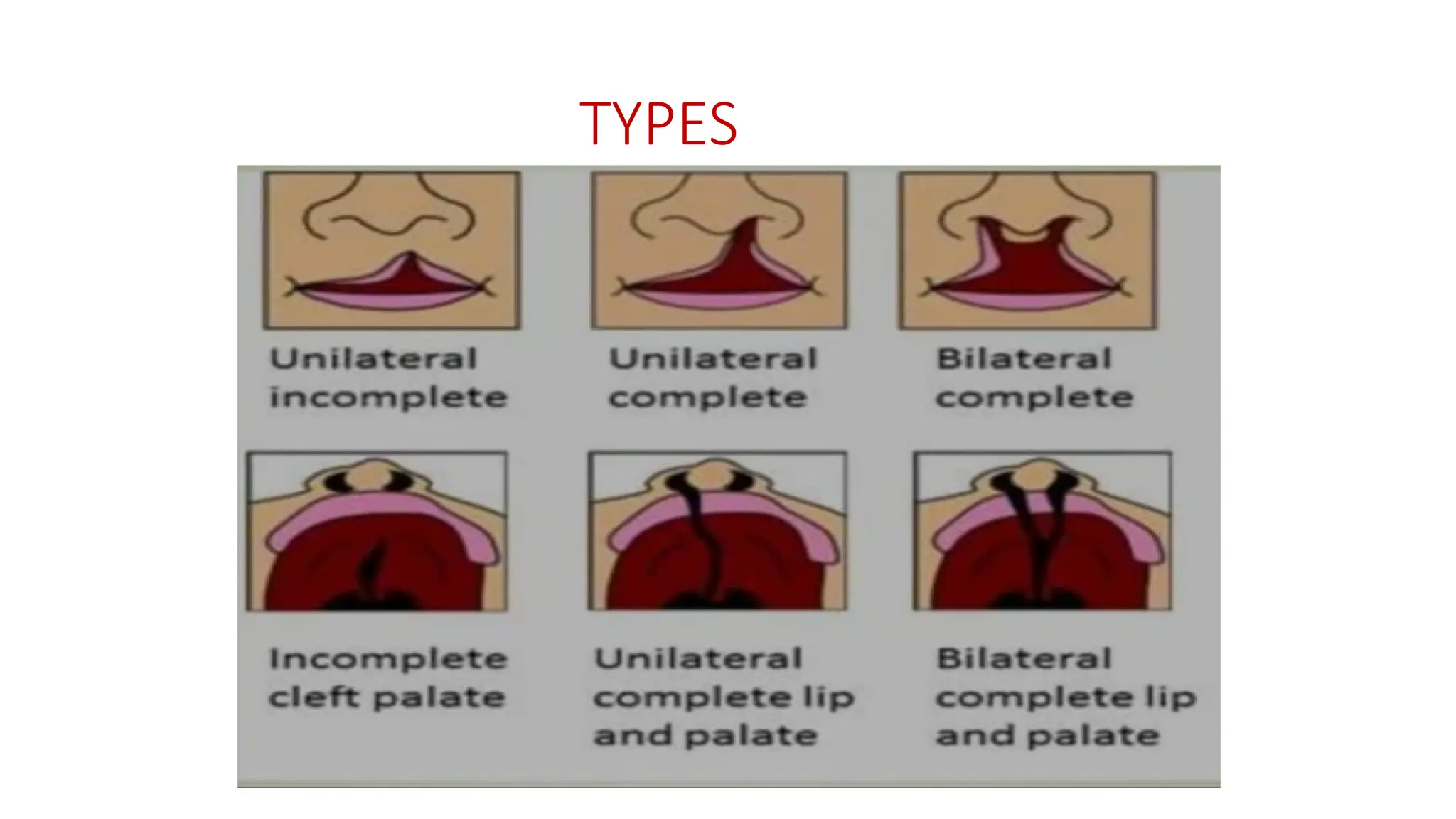 CLEFT LIP AND CLEFT PALATE BY AGNES .pptx