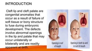 Cleft Lip and Cleft Palate congenital abnormalities of lip and palate | PDF