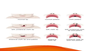Cleft Lip and Cleft Palate congenital abnormalities of lip and palate | PDF