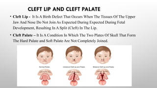 Cleft lip and cleft palate and management. | PPTX