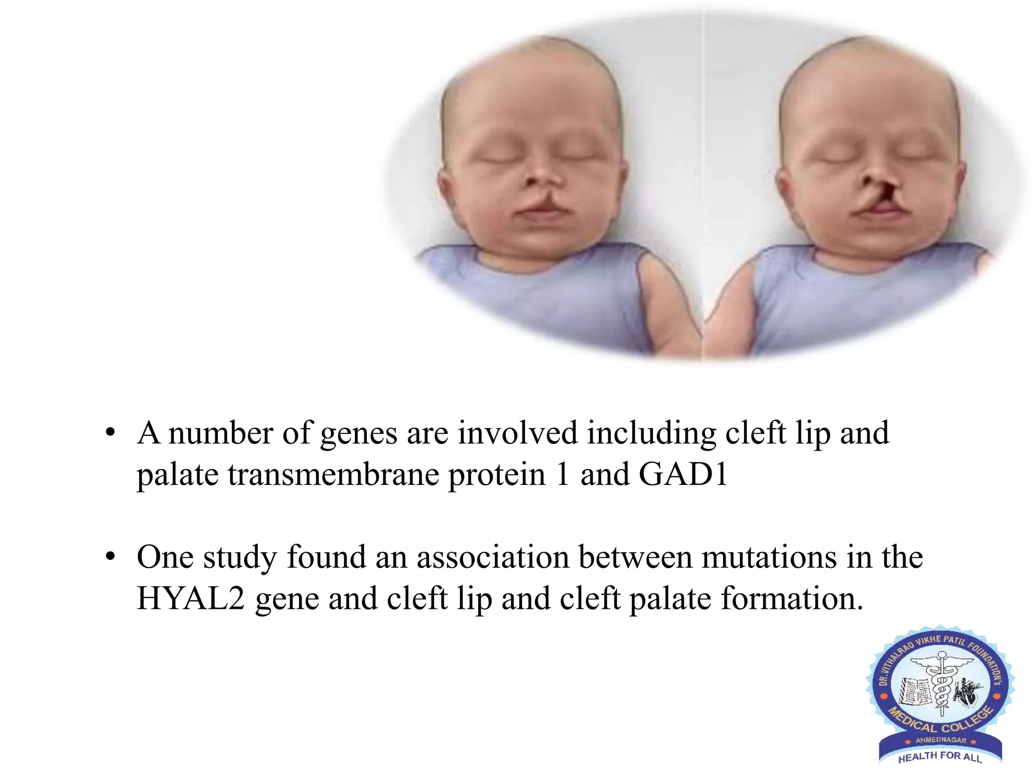 Cleft lip and cleft palate in children | PPTX