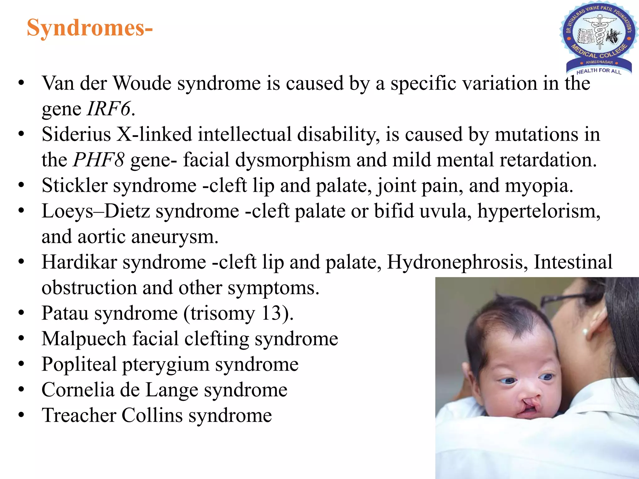 Cleft lip and cleft palate in children | PPTX