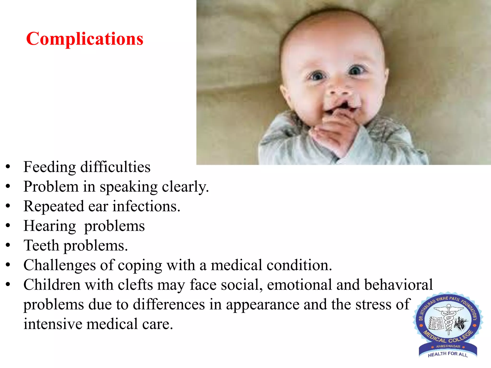 Cleft lip and cleft palate in children | PPTX