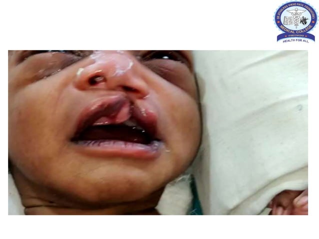 Cleft lip and cleft palate in children | PPTX | Pregnancy | Reproductive Health