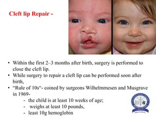 Cleft lip and cleft palate in children | PPTX