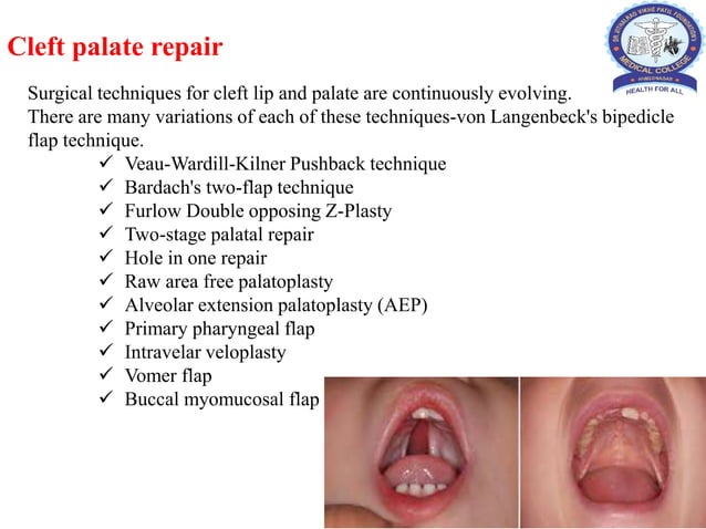Cleft lip and cleft palate in children | PPTX | Pregnancy | Reproductive Health