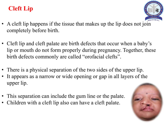 Cleft lip and cleft palate in children | PPTX | Pregnancy | Reproductive Health
