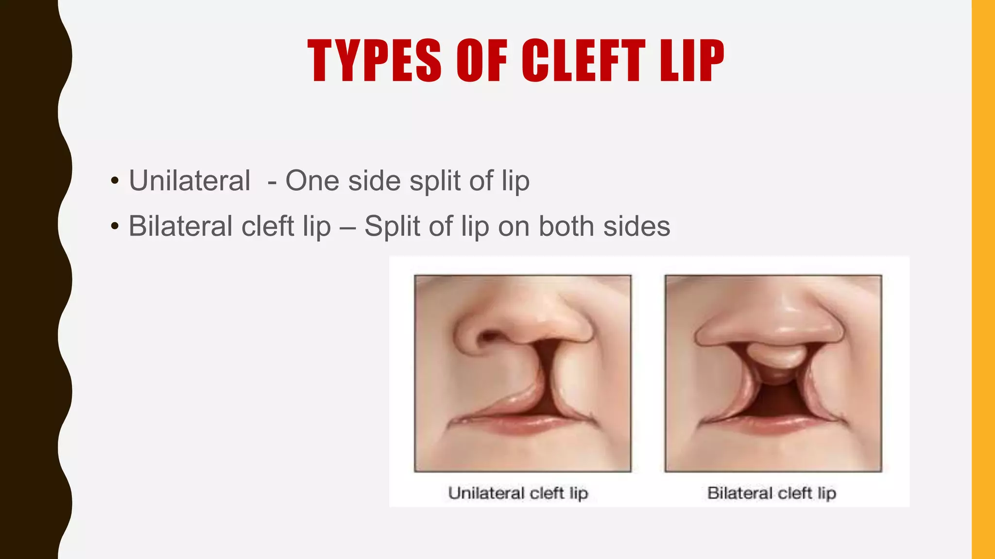 Cleft lip and cleft palate ppt | PPTX