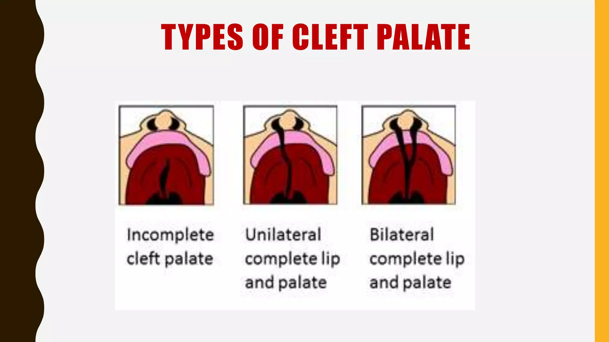 Cleft lip and cleft palate ppt | PPTX
