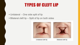 Cleft lip and cleft palate ppt | PPTX