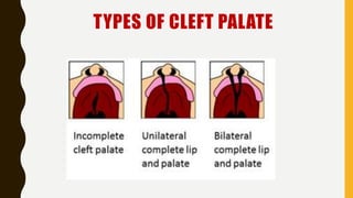 Cleft lip and cleft palate ppt | PPTX
