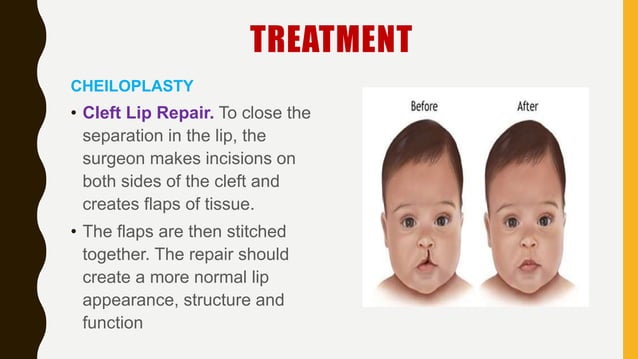 Cleft lip and cleft palate ppt | PPTX