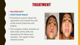 Cleft lip and cleft palate ppt | PPTX