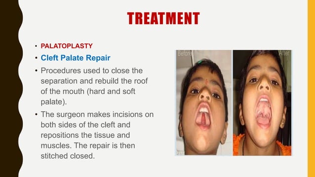 Cleft lip and cleft palate ppt | PPTX