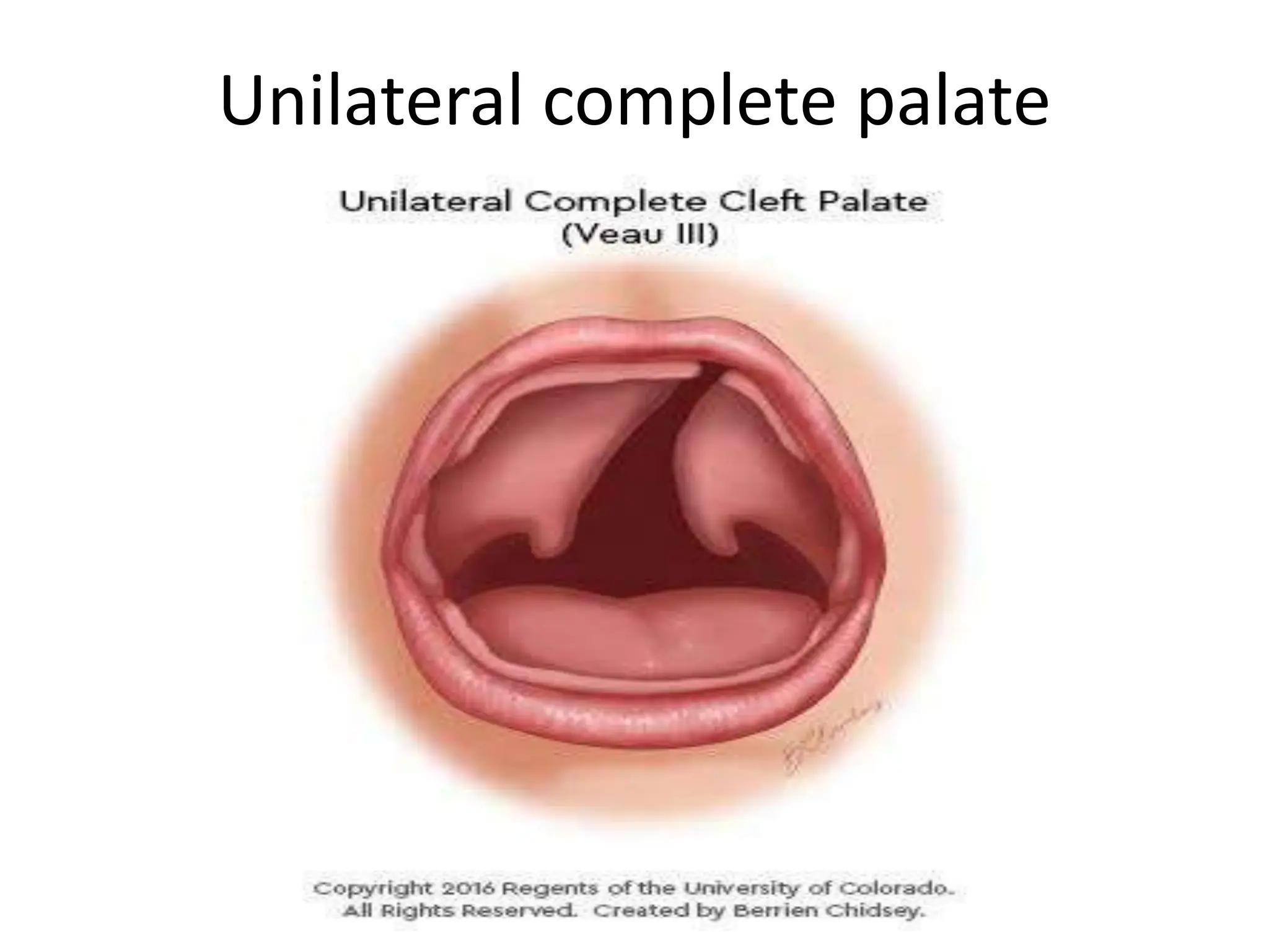 CLEFT LIP AND CLEFT PALATE PPT.pptx child | PPTX