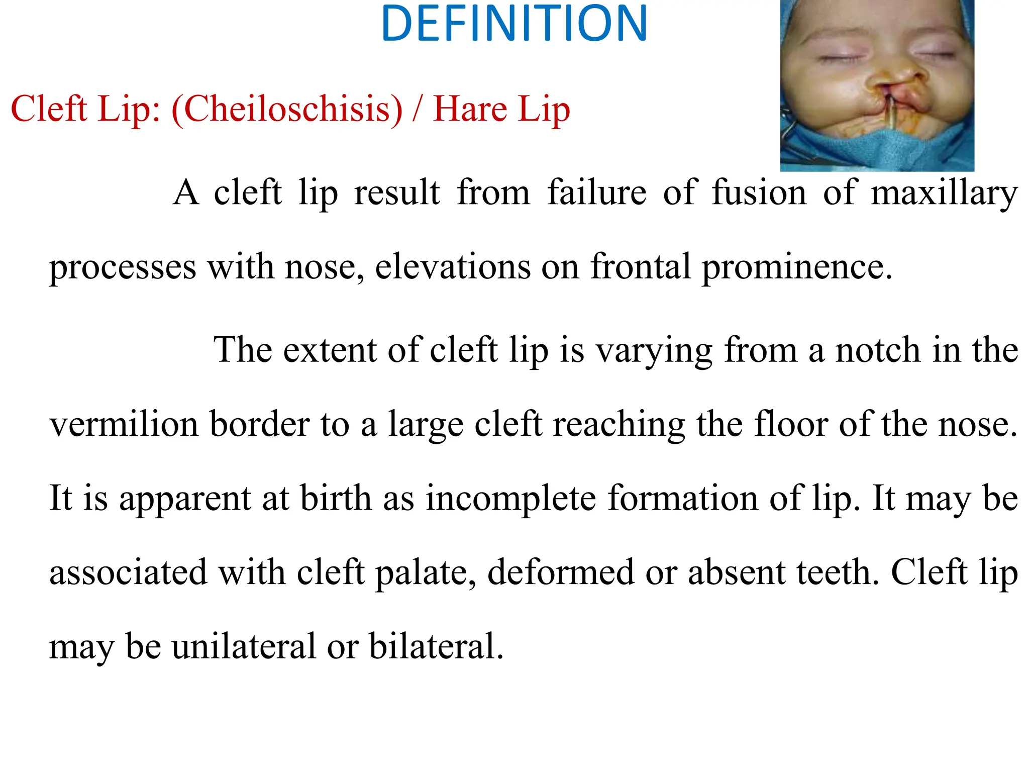 CLEFT LIP AND CLEFT PALATE PPT.pptx child | PPTX