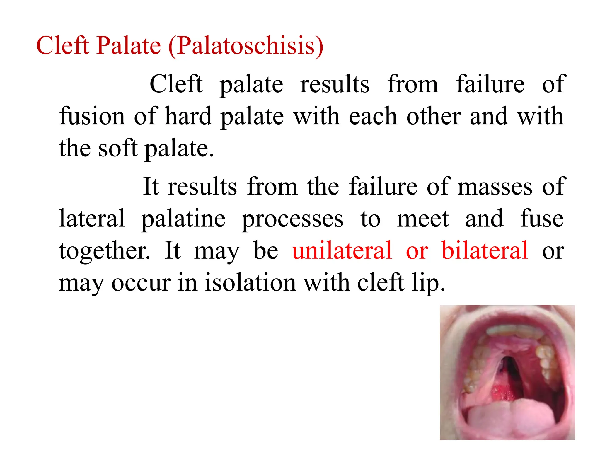 CLEFT LIP AND CLEFT PALATE PPT.pptx child | PPTX