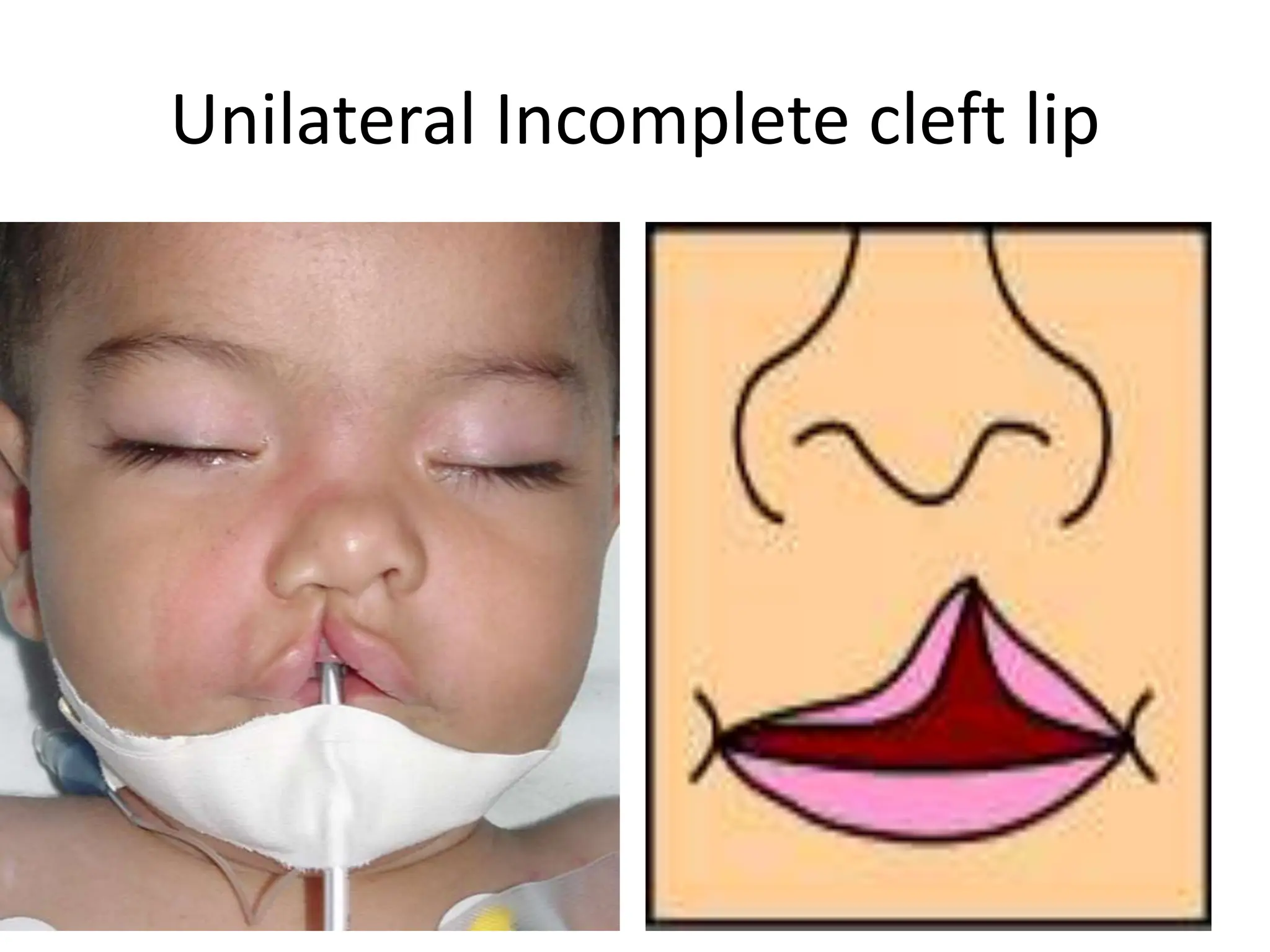 CLEFT LIP AND CLEFT PALATE PPT.pptx child | PPTX