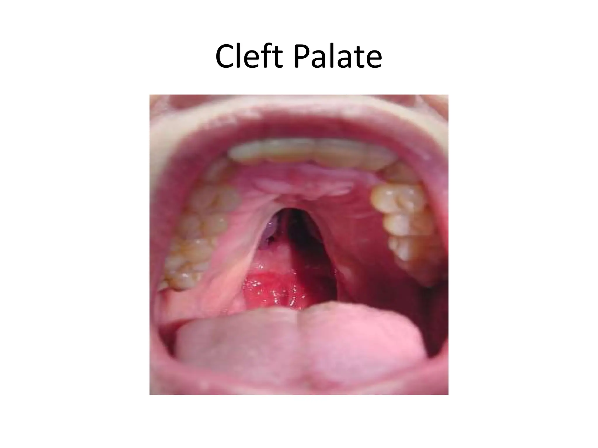 CLEFT LIP AND CLEFT PALATE PPT.pptx child | PPTX